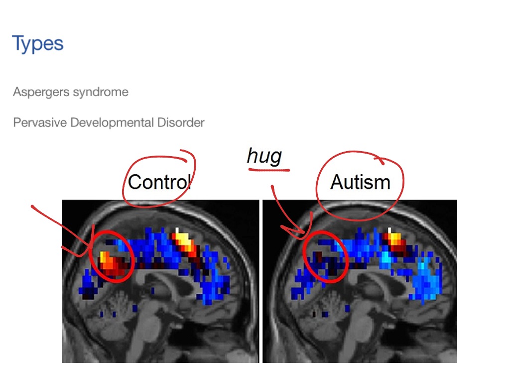 Autism | Science, Biology, Genetics | ShowMe